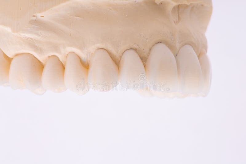 Dental Crowns. Close-up Ceramic Tooth Crown Stock Image - Image of ...
