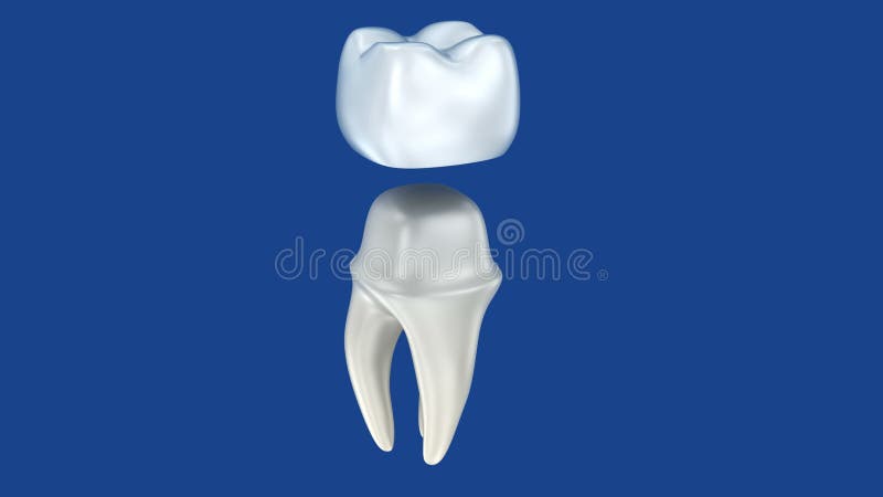 Dental Crowns and Tooth, 3d Concept Stock Footage - Video of caps ...