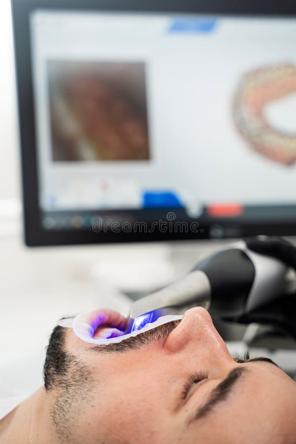 Dental 3d Scanner Applying Process. Digital Impressioning Teeth of ...