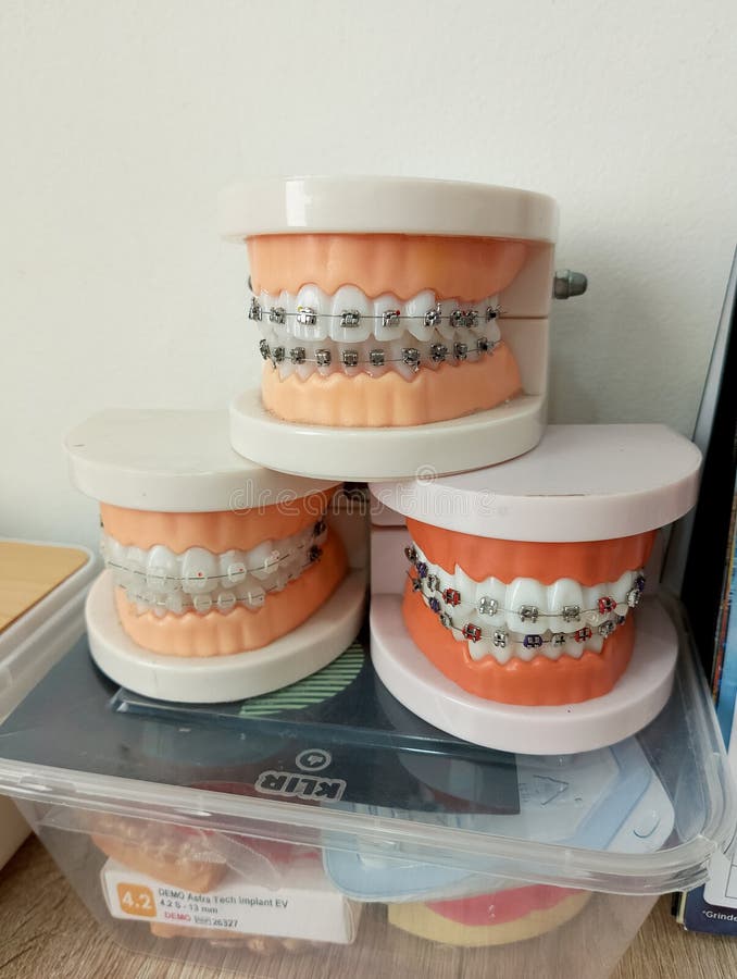 Orthodontic Education: a Close Look at Braces and Implants Editorial ...