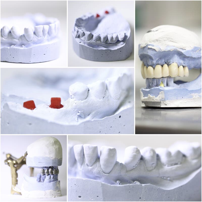 Dental Dentist Objects Collage Stock Image - Image of dentures, ceramic ...