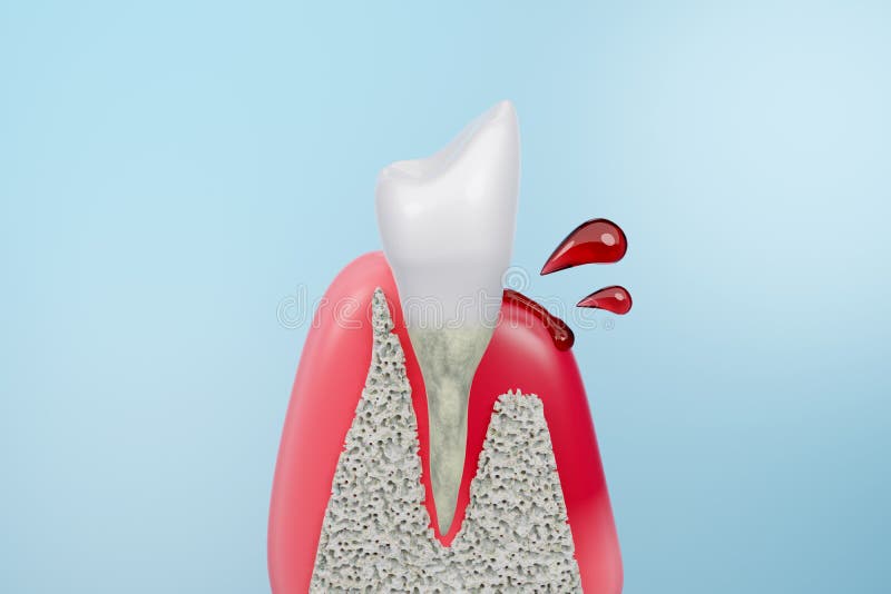 Dental Gum Disease, Bleeding at Root of Teeth Stock Illustration ...