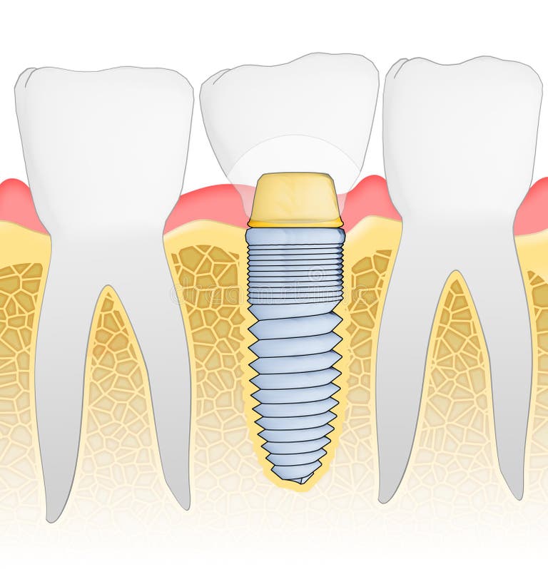 Dental Implantation Model Stock Illustrations – 1,300 Dental ...