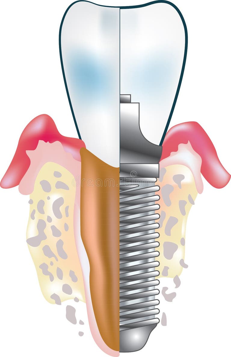Dental Implant Surgery Stock Illustrations – 5,311 Dental Implant ...
