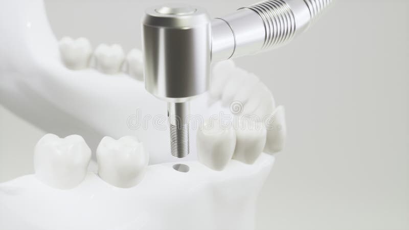 Dental Implant on the Example of a Jaw Model - 3D Rendering Stock ...