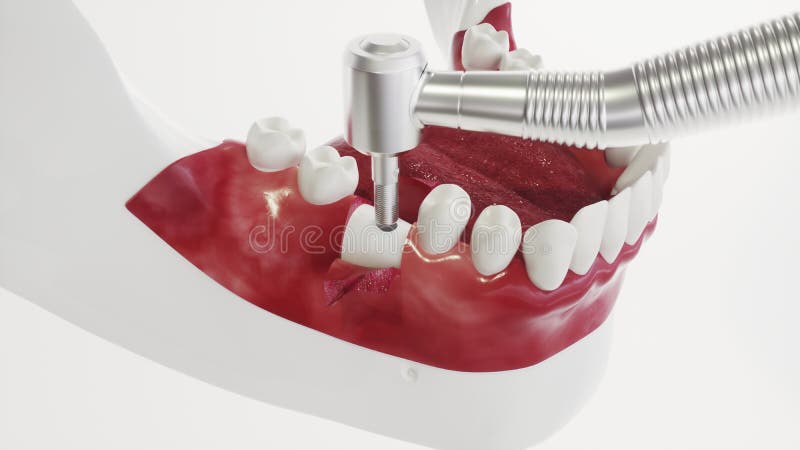 Dental Implant on the Example of a Jaw Model - 3D Rendering Stock ...