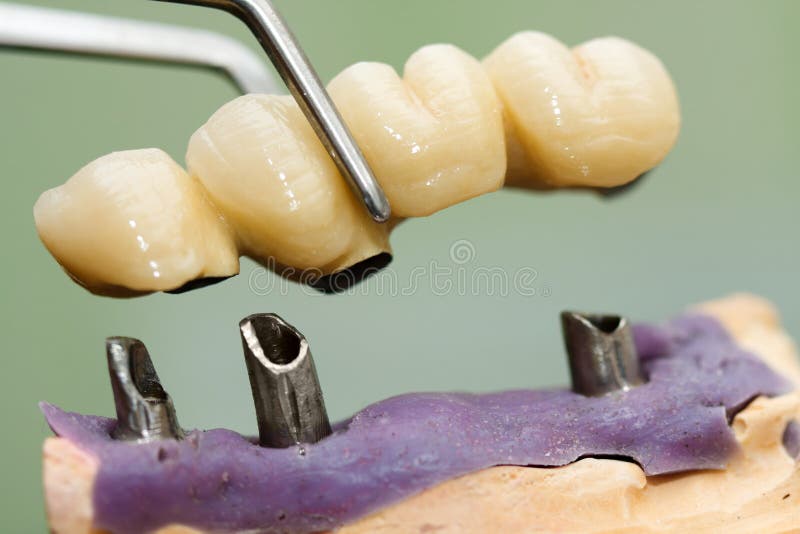 Dental Implant Head and Bridge Stock Photo - Image of prosthetics, cast ...