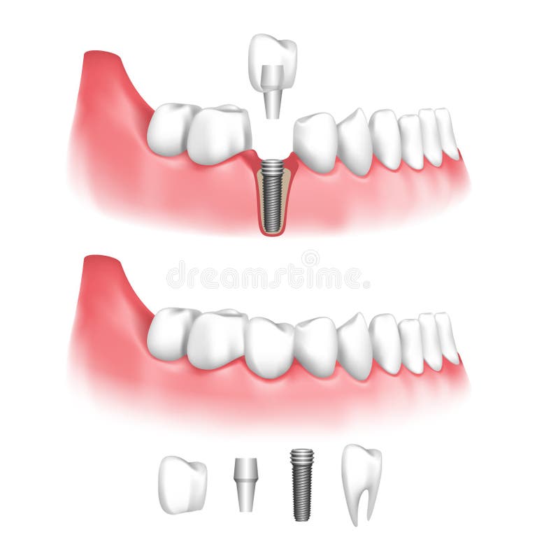 Dental Implant Anatomy Drawing Stock Illustrations – 493 Dental Implant ...