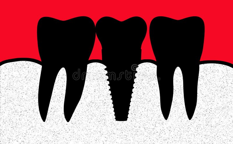 A Dental Implant, an Implanted Tooth is Seen between Two Normal Teeth ...