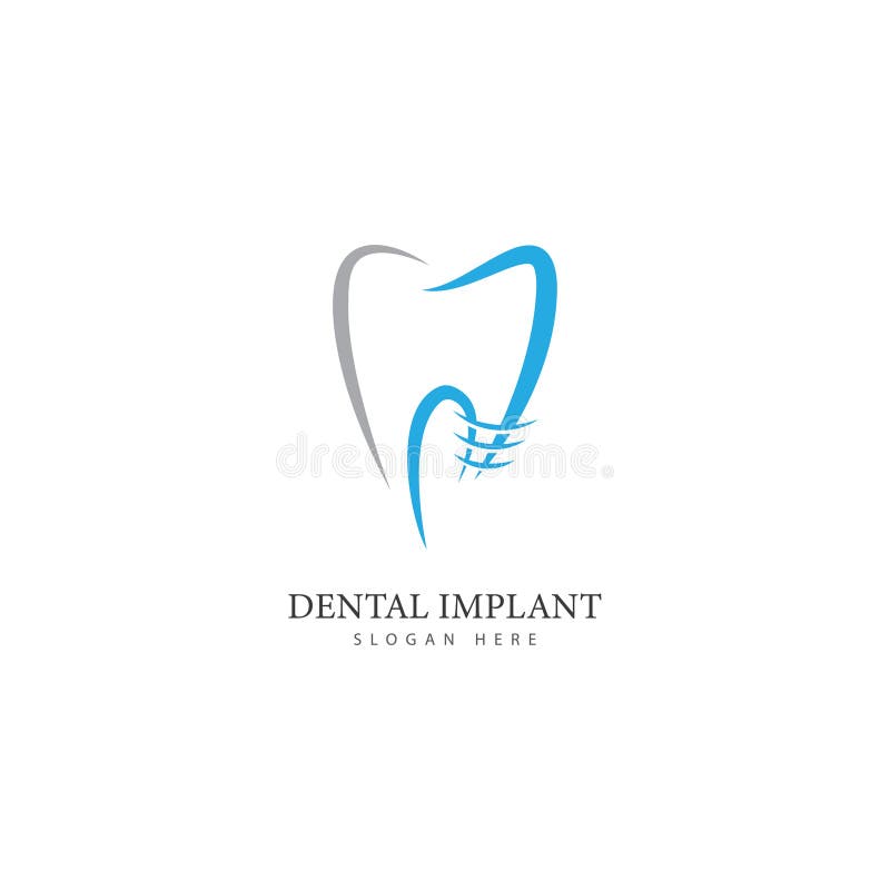 Dental Implant Logo Design Concept Vector Dental Care Logo Template ...