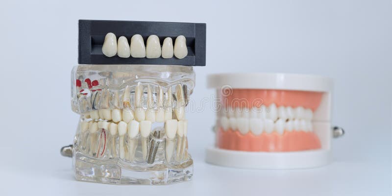 Dental Implant Model with Artificial Teeth Display Stock Image - Image ...