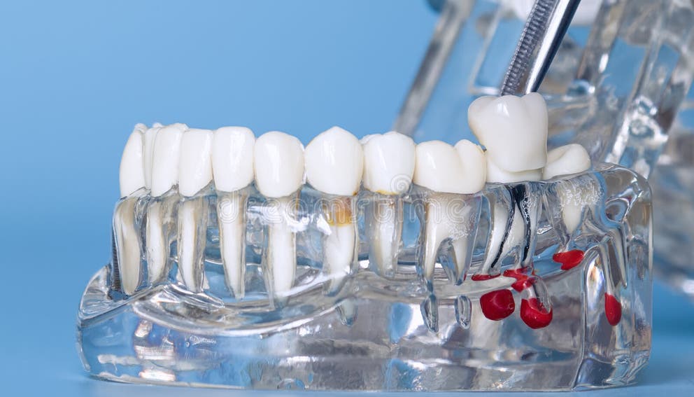 Dental Implant Model Showing Tooth Crown Placement Stock Image - Image ...