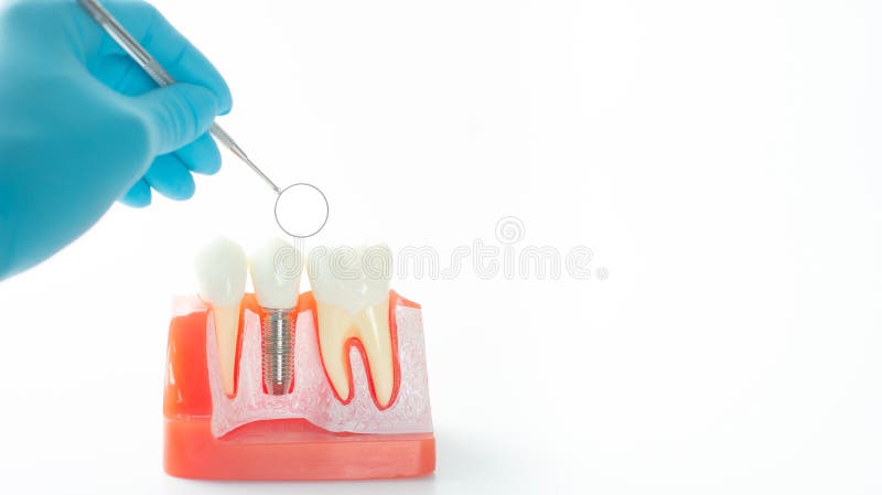 Dental Implant Model on White Background Stock Photo - Image of ...