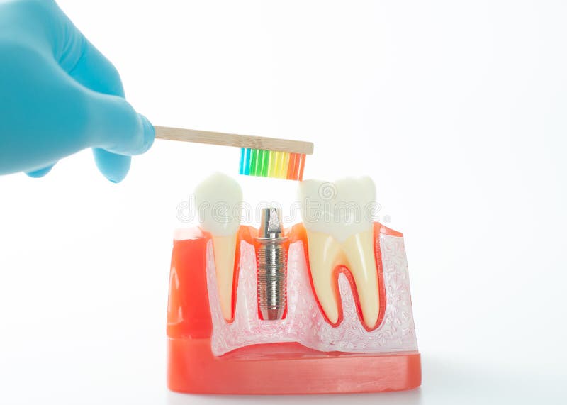 Dental Implant Model on White Background Stock Photo - Image of model ...