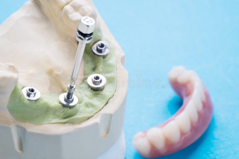 Dental Implant Temporary Abutment Stock Photo - Image of components ...