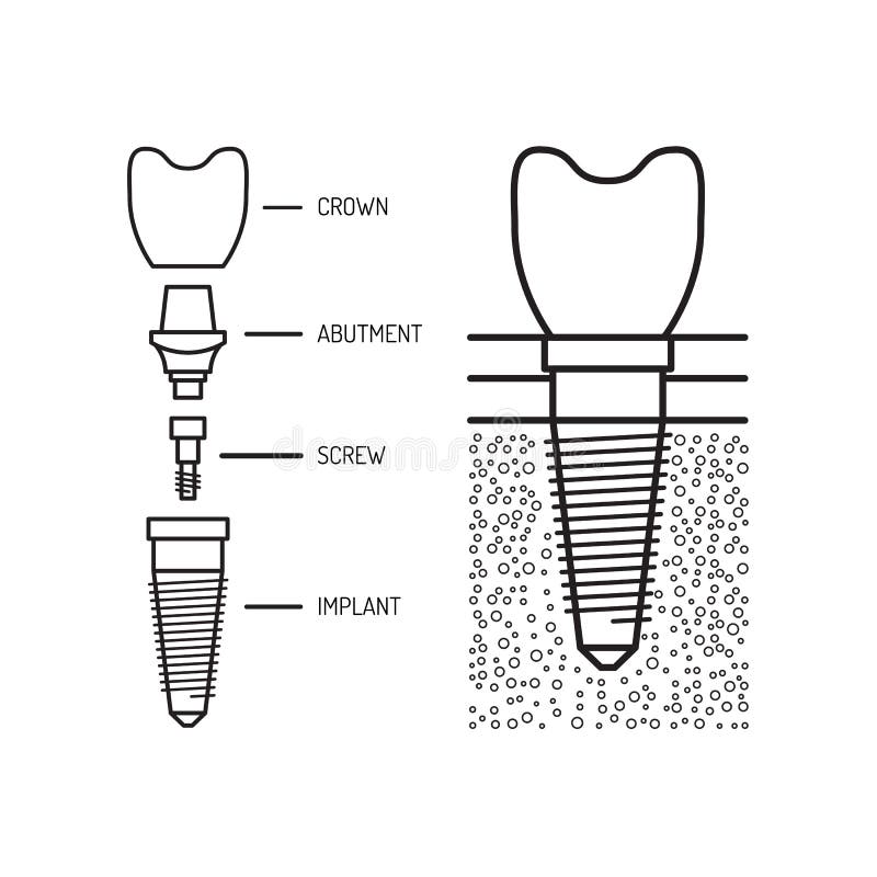 Dental Implant Flat Vector Illustration / Implant In Jaw Bone Stock ...