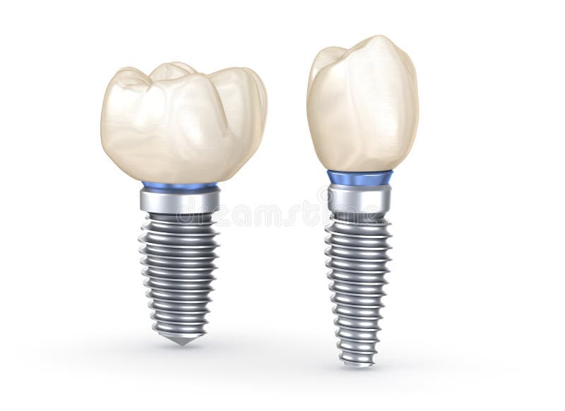 Dental Implants. 3D Illustration Concept of Human Teeth Stock ...