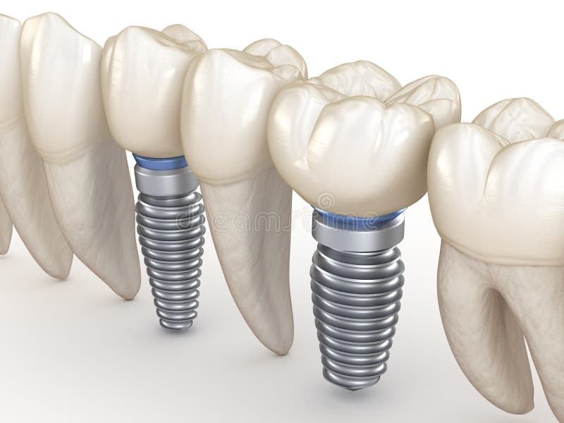 Dental Implants in Line. 3D Illustration Concept of Human Teeth Stock ...