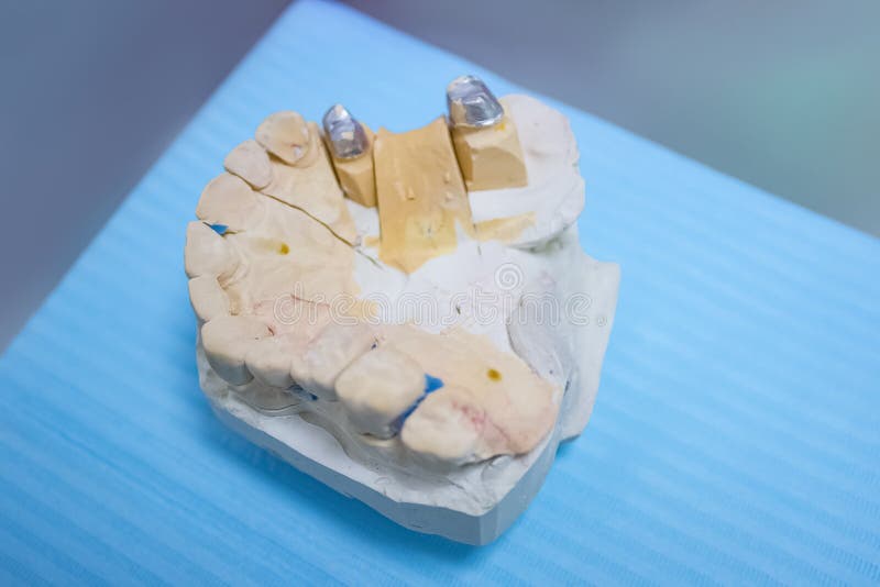 Dental Implants. Restore Lost Teeth Stock Photo - Image of dentist ...