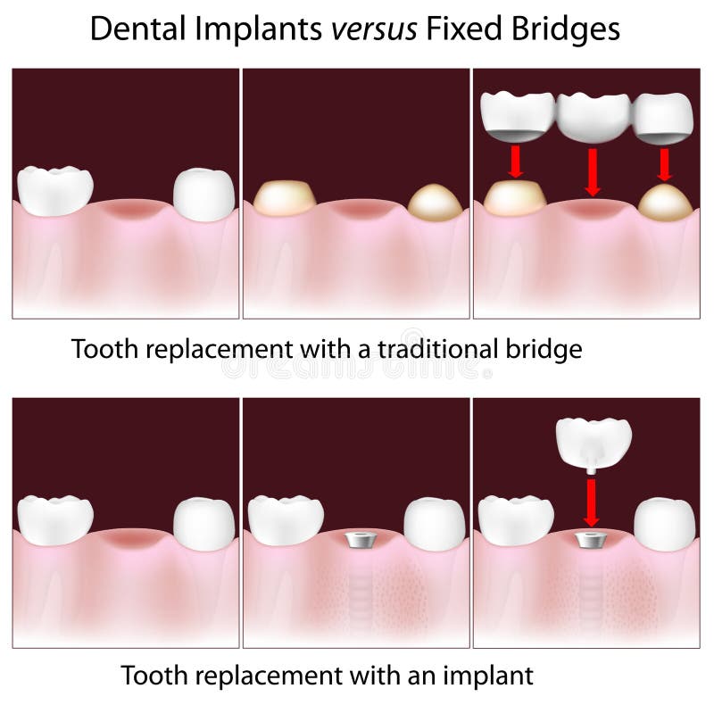 Dental Implants Versus Fixed Bridges Stock Vector - Illustration of ...