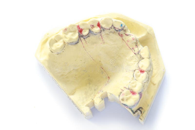 Dental Impression Model with Laboratory Design Stock Photo - Image of ...