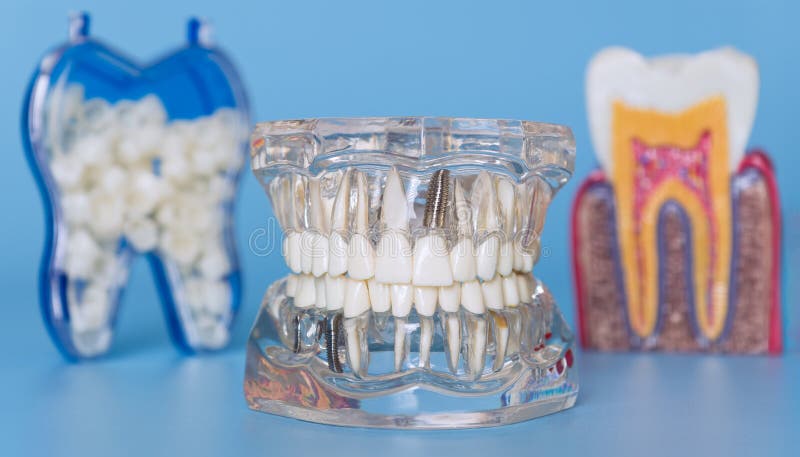 Dental Jaw Model with Implants and Tooth Anatomy Background Stock Image ...