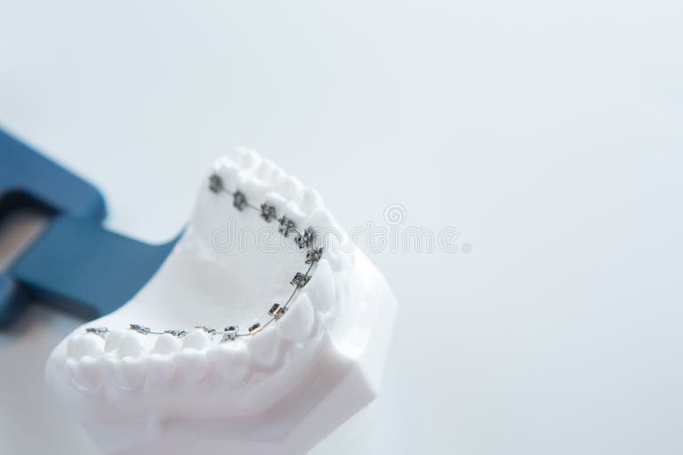 Dental Lower Jaw Bracket Braces Model on White Stock Photo - Image of ...