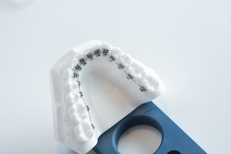 Dental Lower Jaw Bracket Braces Model on White Stock Image - Image of ...