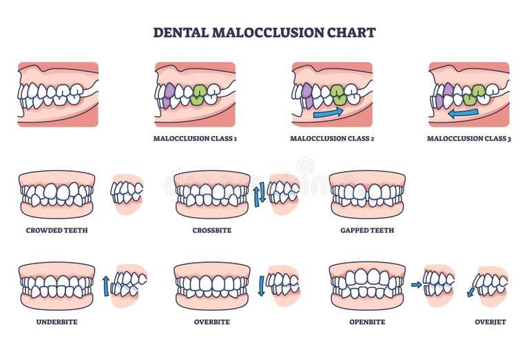 Dental Malocclusion Chart Shows Types of Teeth Misalignment, Including ...