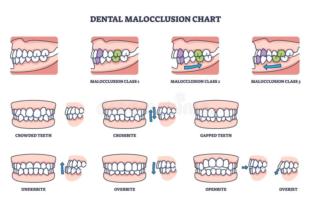 Dental Malocclusion Chart Shows Types of Teeth Misalignment, Including ...