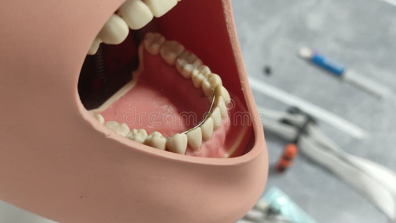 Dental Mannequin for Dental Students with a Dental Splint Placed on the ...