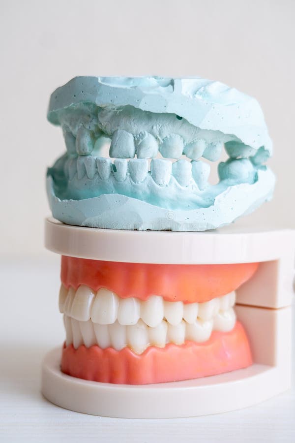 Dental Model and Plaster Cast of Human Teeth Stock Image - Image of ...