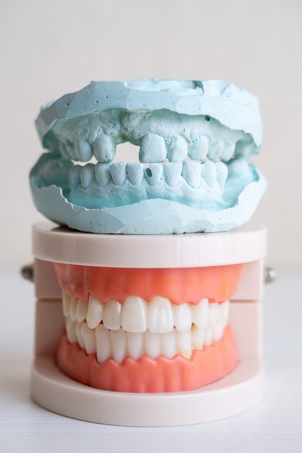 Dental Model and Plaster Cast of Human Teeth Stock Image - Image of ...