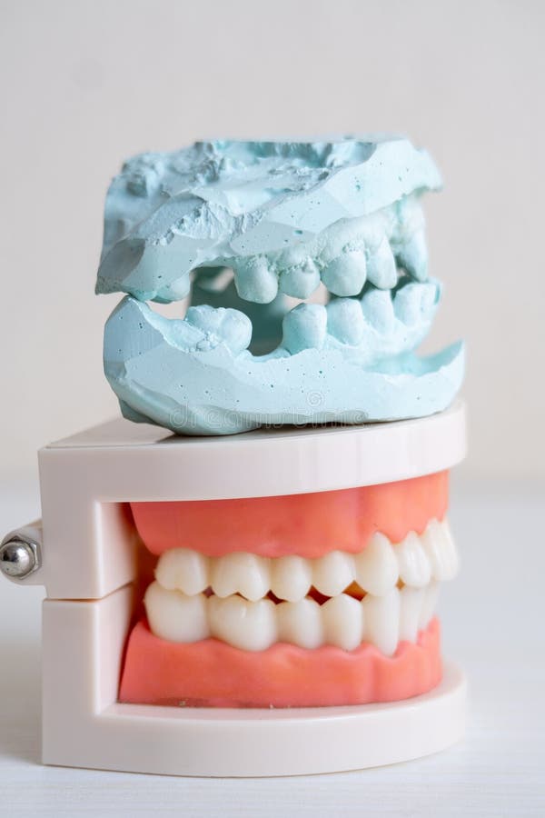 Plaster Cast of Teeth. Future Implants Stock Photo - Image of ...