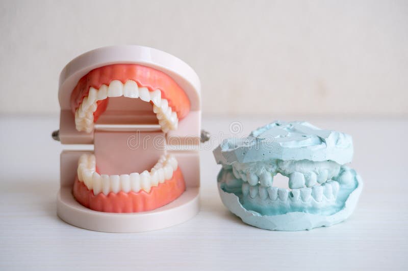 Dental Model and Plaster Cast of Human Teeth Stock Image - Image of ...