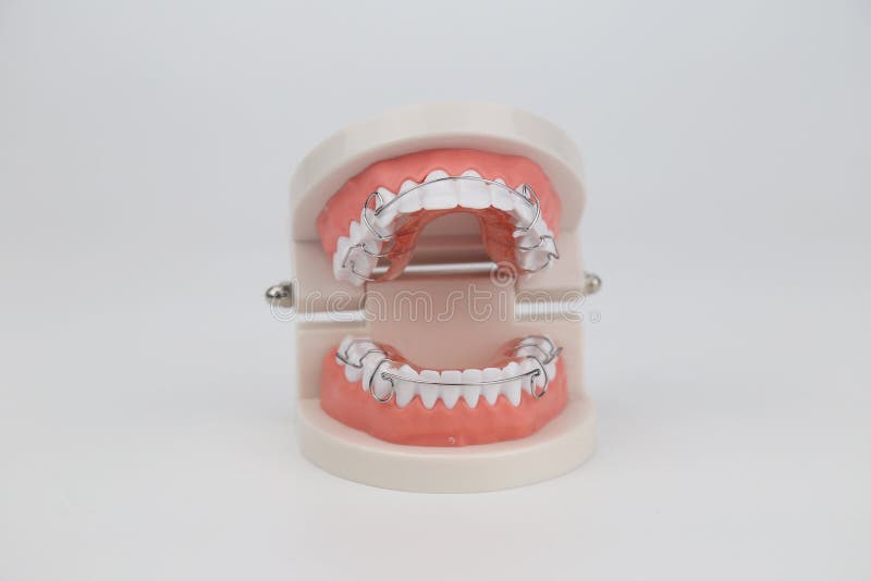 Dental model with retainer stock photo. Image of white - 84917504