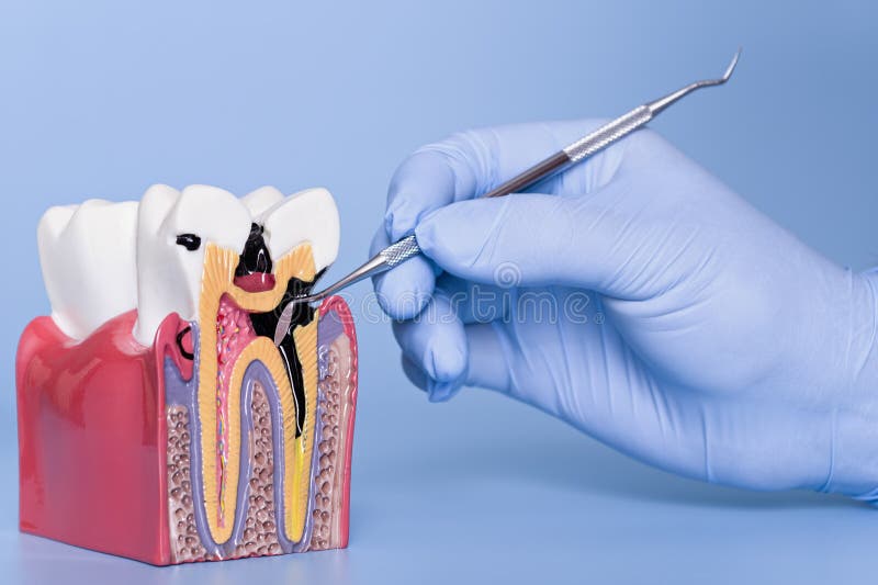 Dental Model with Severe Tooth Decay Examination Stock Image - Image of ...
