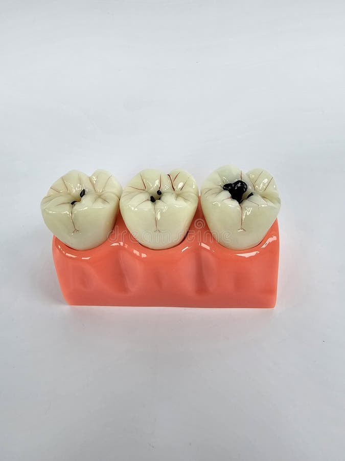 Dental Model Showcasing Three Teeth with Varying Levels of Decay Stock ...