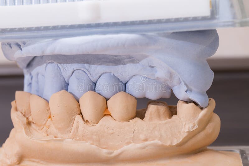 Dental Mold for Prosthetic Teeth Stock Image - Image of care, cermet ...