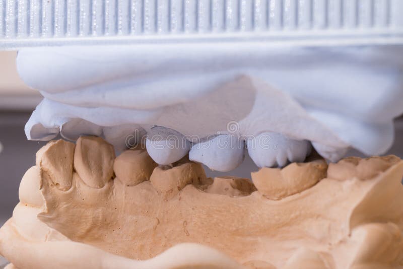 Dental Mold for Prosthetic Teeth Stock Image - Image of assembling ...