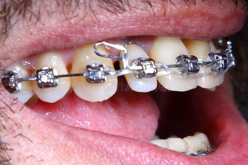 Dental Office. Installation of Dental Braces at the Dentist. the ...