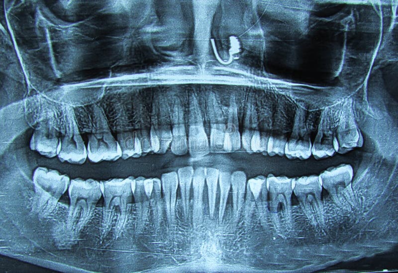 206 Orthopantomogram Stock Photos - Free & Royalty-Free Stock Photos ...