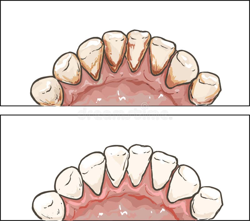 Dental Plaque Cause To Periodontal Disease Vector Image Stock Vector ...