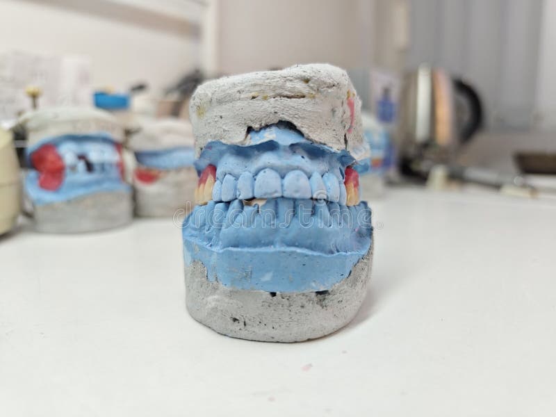 Dental Plaster Models with Denture Analogs in the Dental Laboratory ...