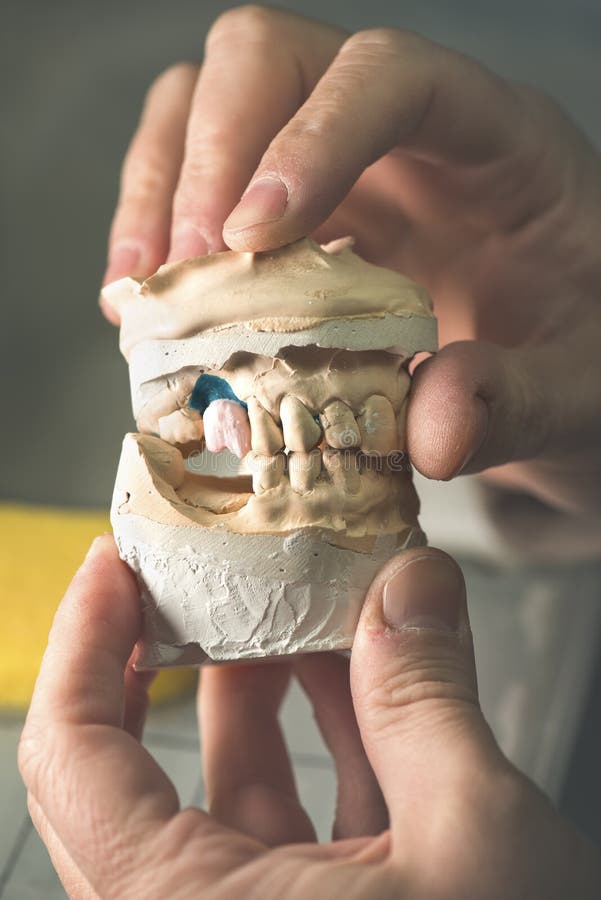 Dental Prosthesis stock image. Image of mastication, ceramic - 86684313