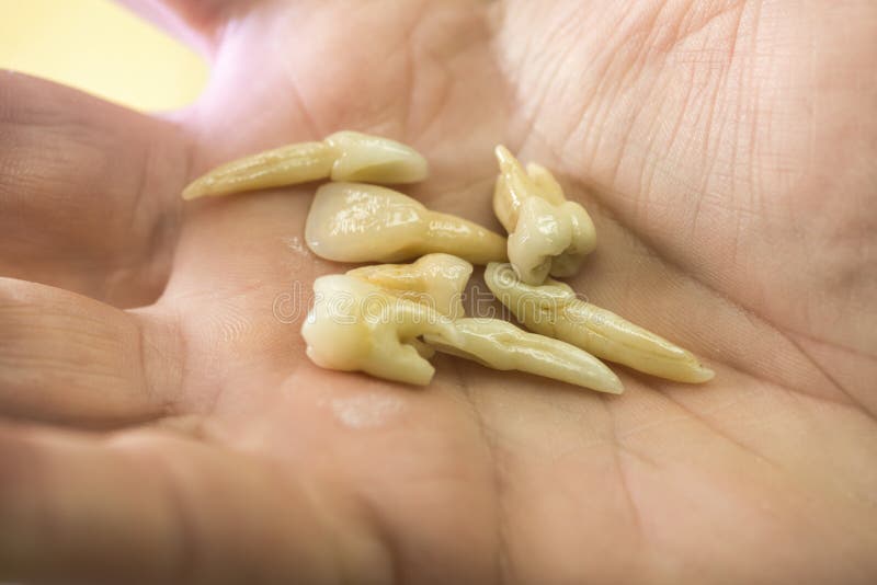 Dental Prosthesis stock photo. Image of nail, dentist - 88075104