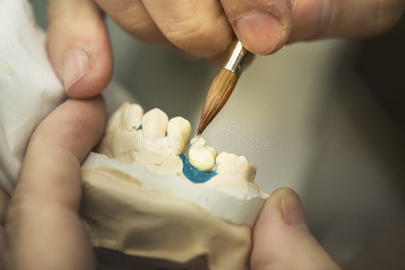Dental Prosthesis stock image. Image of bite, clinic - 88308187
