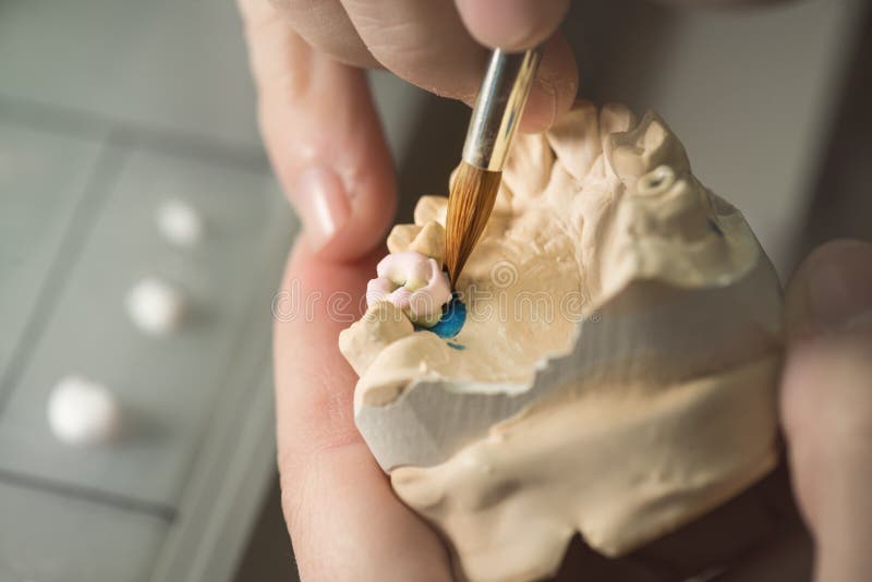 Dental Prosthesis stock image. Image of artificial, axillary - 88787849