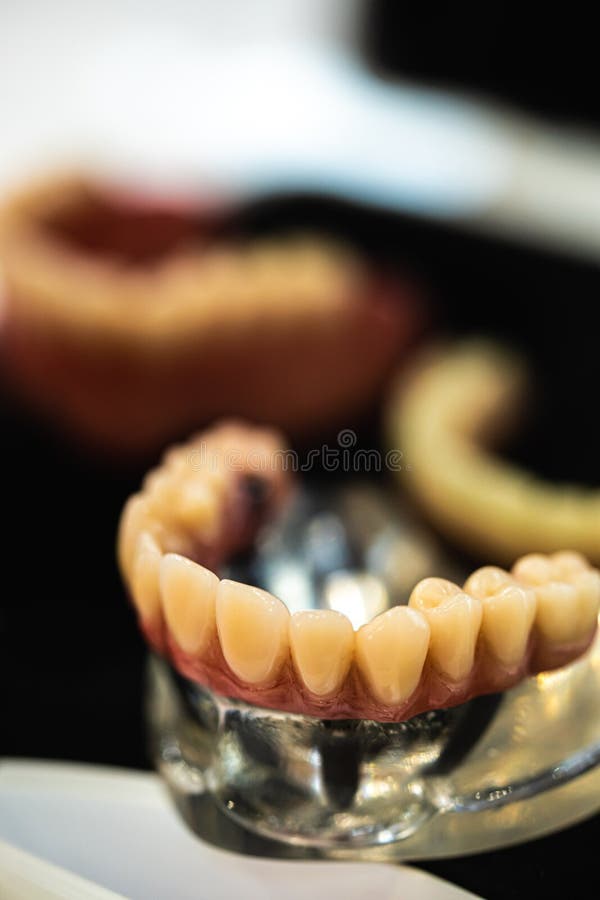 Dental Prosthesis with Metal Stock Image - Image of human, bite: 259901029