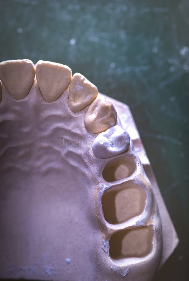 Dental Prosthesis Prosthetic Laboratory Stock Photo - Image of dental ...